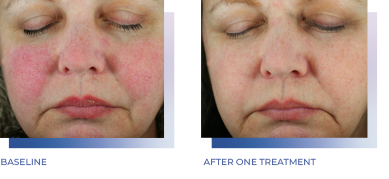 Glacial Rx: Pigment Freezing Treatment | Mt. Juliet+Lebanon