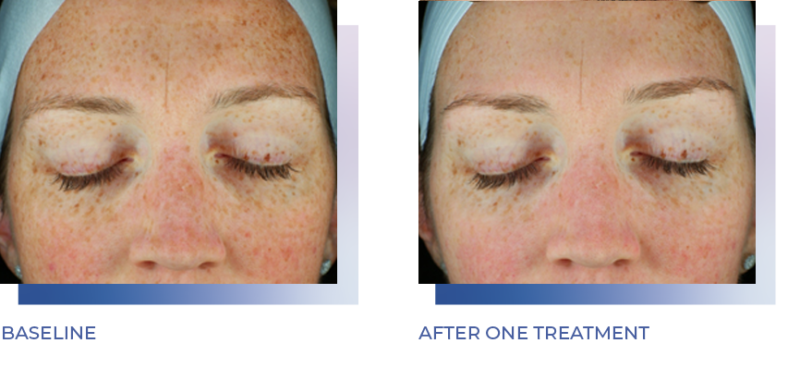 Glacial Rx: Pigment Freezing Treatment | Mt. Juliet+Lebanon