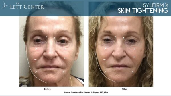 Sylfirm X, RF Microneedling | Mt. Juliet & Lebanon, TN